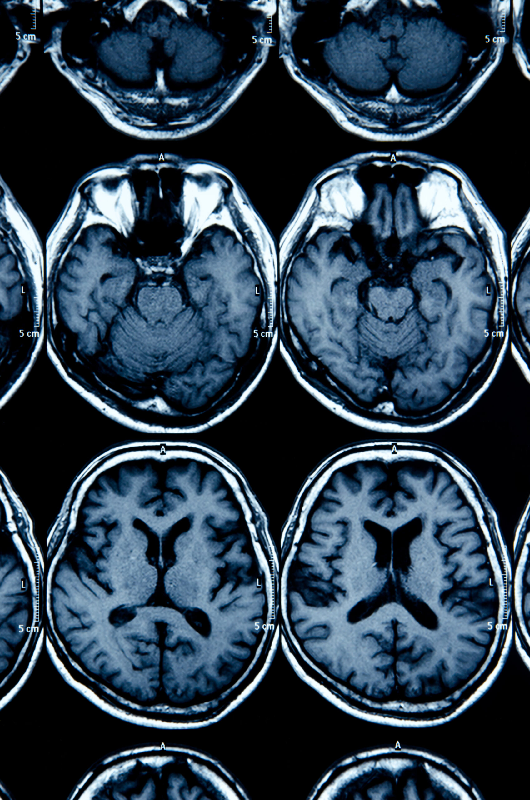 Understanding Traumatic Brain Injuries from Wisconsin Car Accidents ...